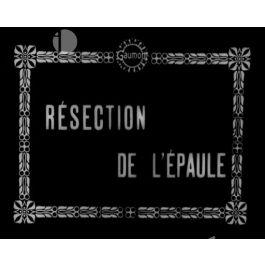 ImagesDéfense - Résection de l'épaule. Désarticulation sous-astragalienne.